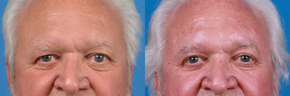 Male Brow Lift Photos | Melbourne, FL | Patient 30992
